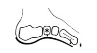 Orthotic Posting - Allied OSI Labs