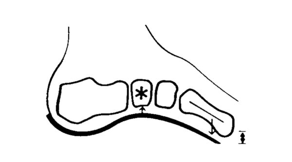 Orthotic Posting - Allied OSI Labs