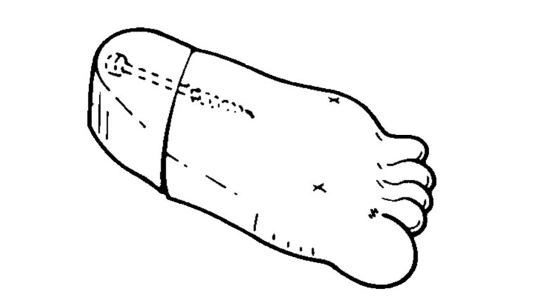 Orthotic Posting - Allied OSI Labs