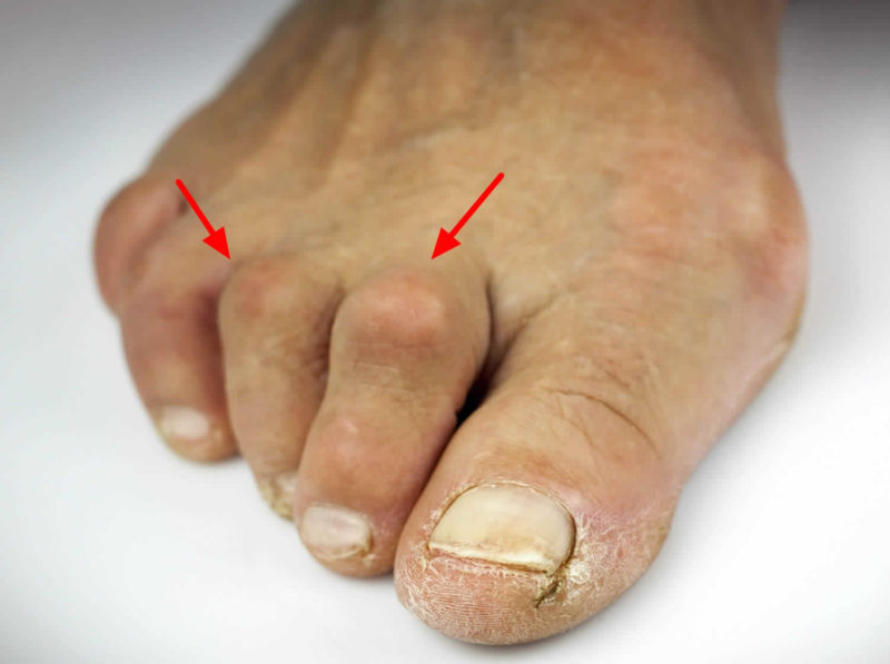 Hammer Toes / Claw Toes - Allied OSI Labs